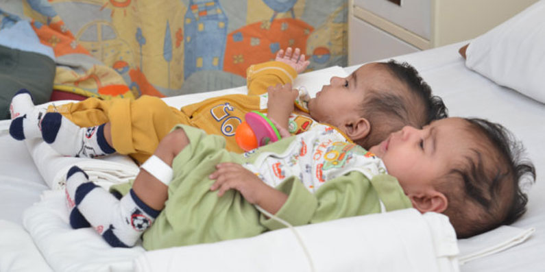 AKUH performs successful surgery on conjoined twins | The Aga Khan ...